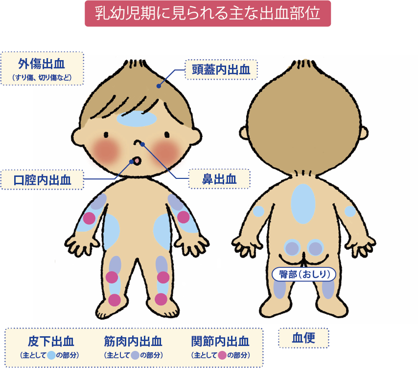 乳幼児期によくある出血と手当て 1乳幼児期よくある出血｜小さな血友病のお子さんと保護者の方｜ヘモフィリア・ヴィレッジ｜バイエル薬品株式会社